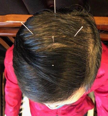 The Ultimate Guide to the Acupuncture Point on Head for Headaches » Art ...