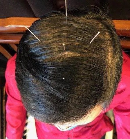 The Ultimate Guide to the Acupuncture Point on Head for Headaches » Art ...